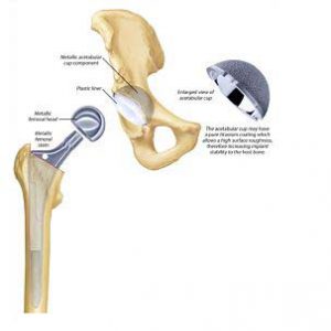 Total Hip Replacement Surgery - DR. SARANG DESHPANDE